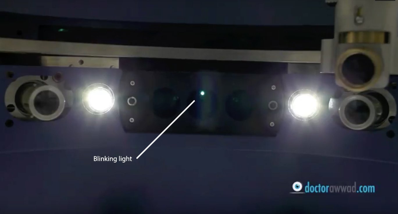 Laser Surface Ablation (PRK/TransPRK) | Dr Shady Awwad, eye surgeon at ...